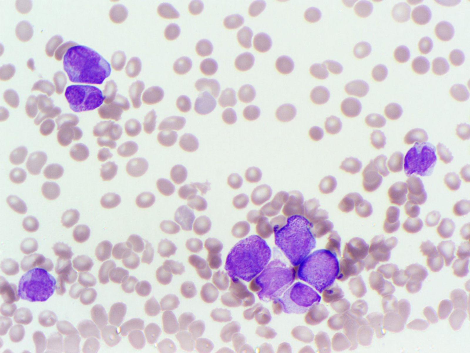 Hypergranular APML – Only Cells