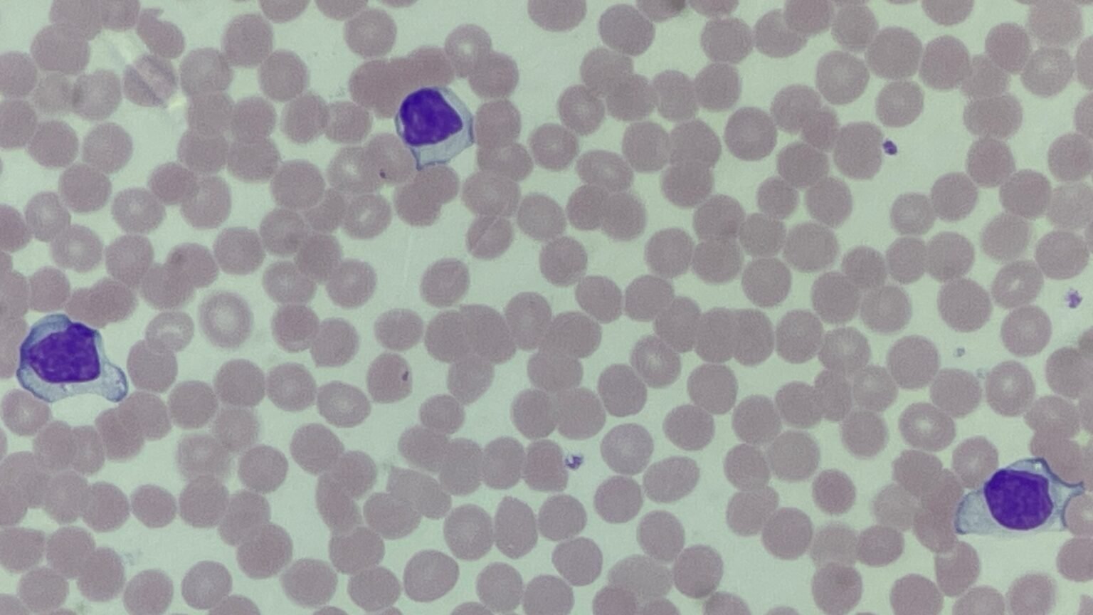 Infectious mononucleosis: when lymphocytes take centre stage – Only Cells