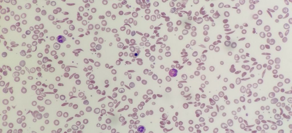 Red cells: Drepanocytes – Only Cells