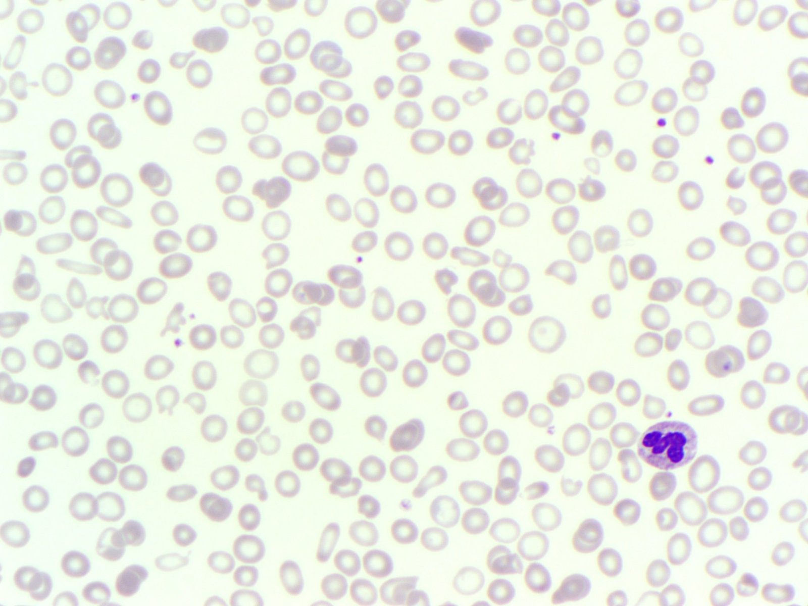 Red cells: Hypochromia – Only Cells
