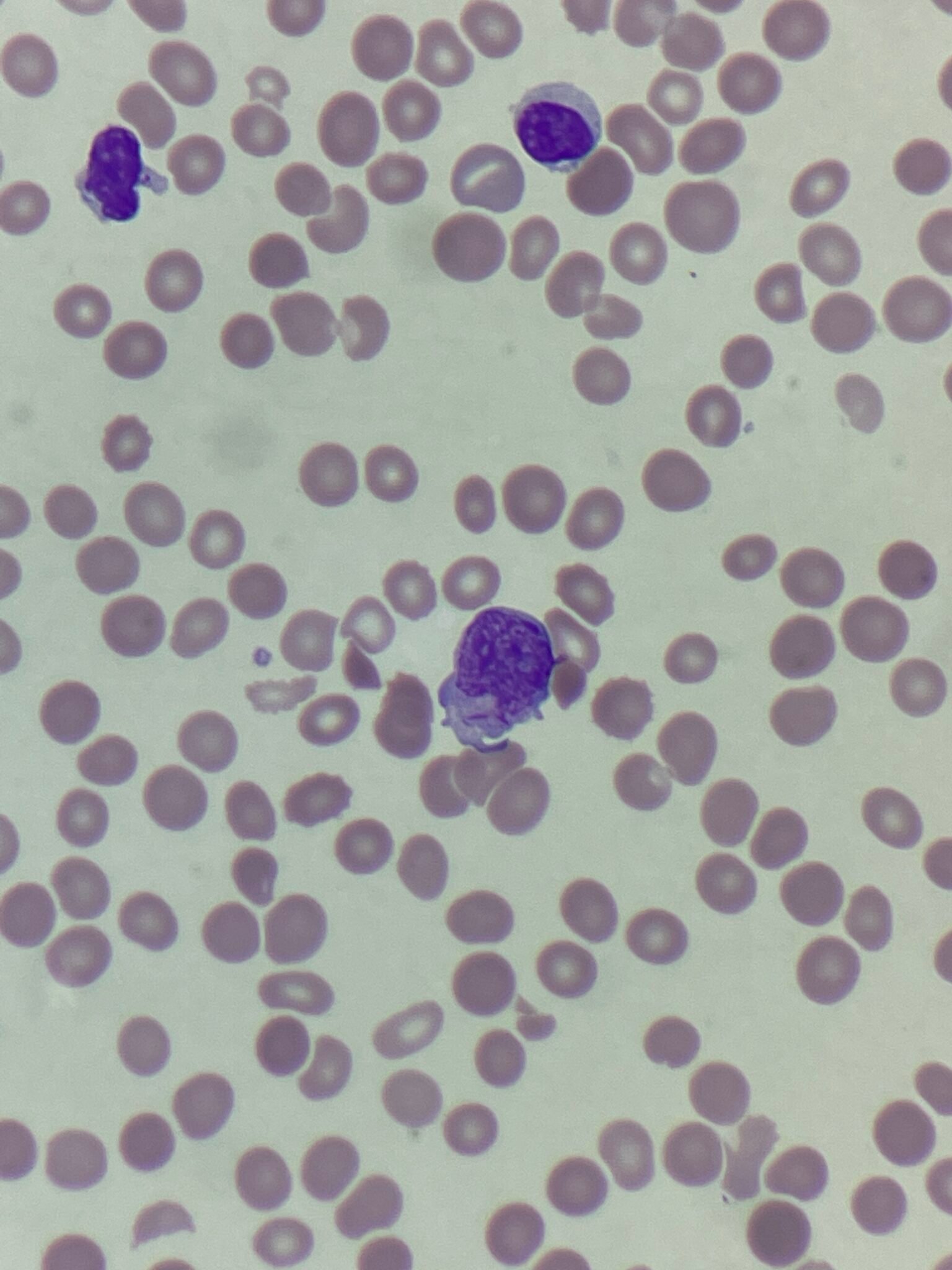 MM251013: Acute promyelocytic leukaemia (APML) – Only Cells