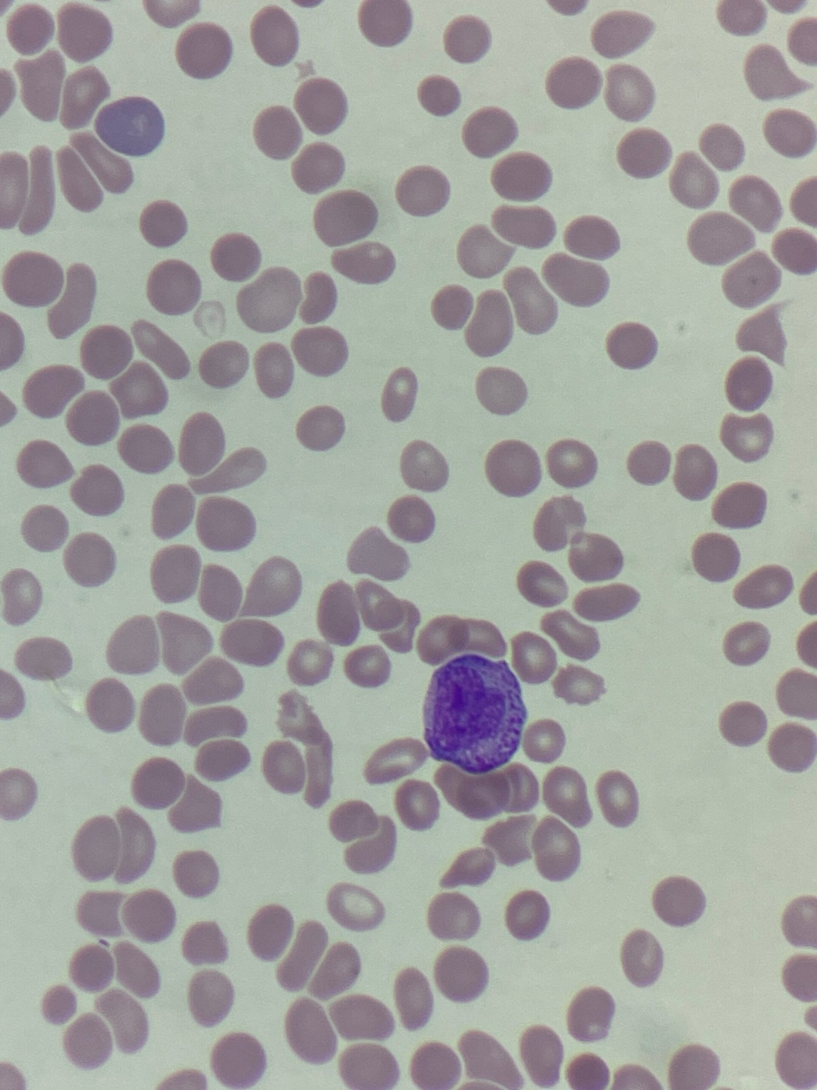 MM251013: Acute promyelocytic leukaemia (APML) – Only Cells