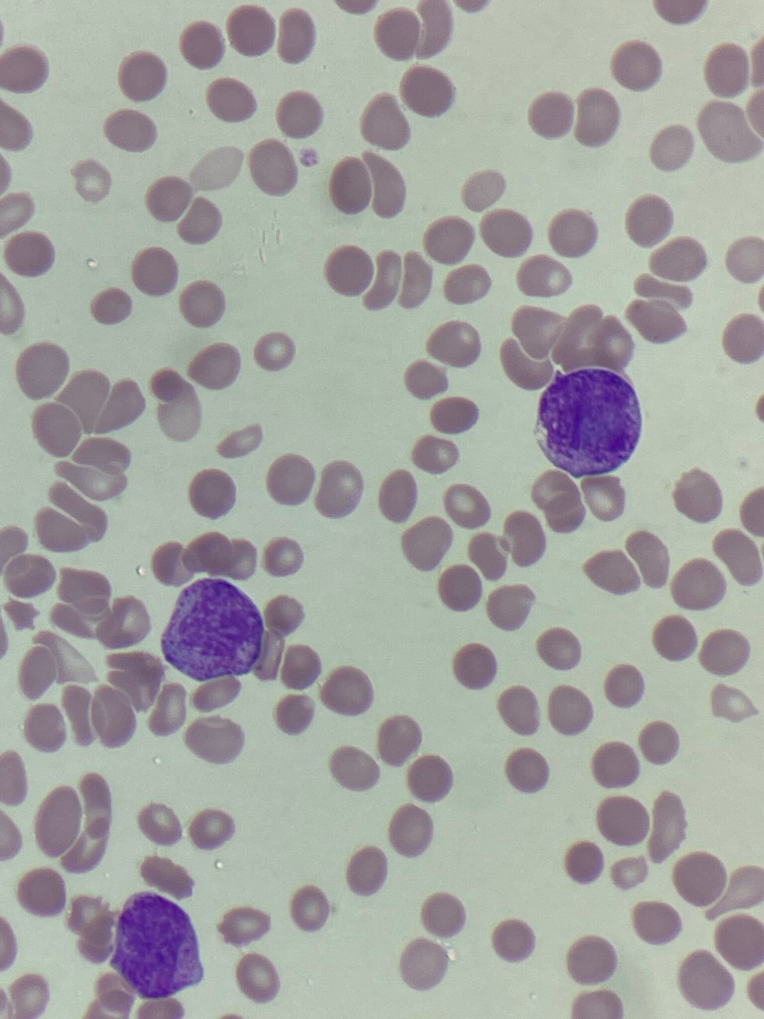 MM251013: Acute promyelocytic leukaemia (APML) – Only Cells