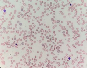Red cells: Spherocytes – Only Cells