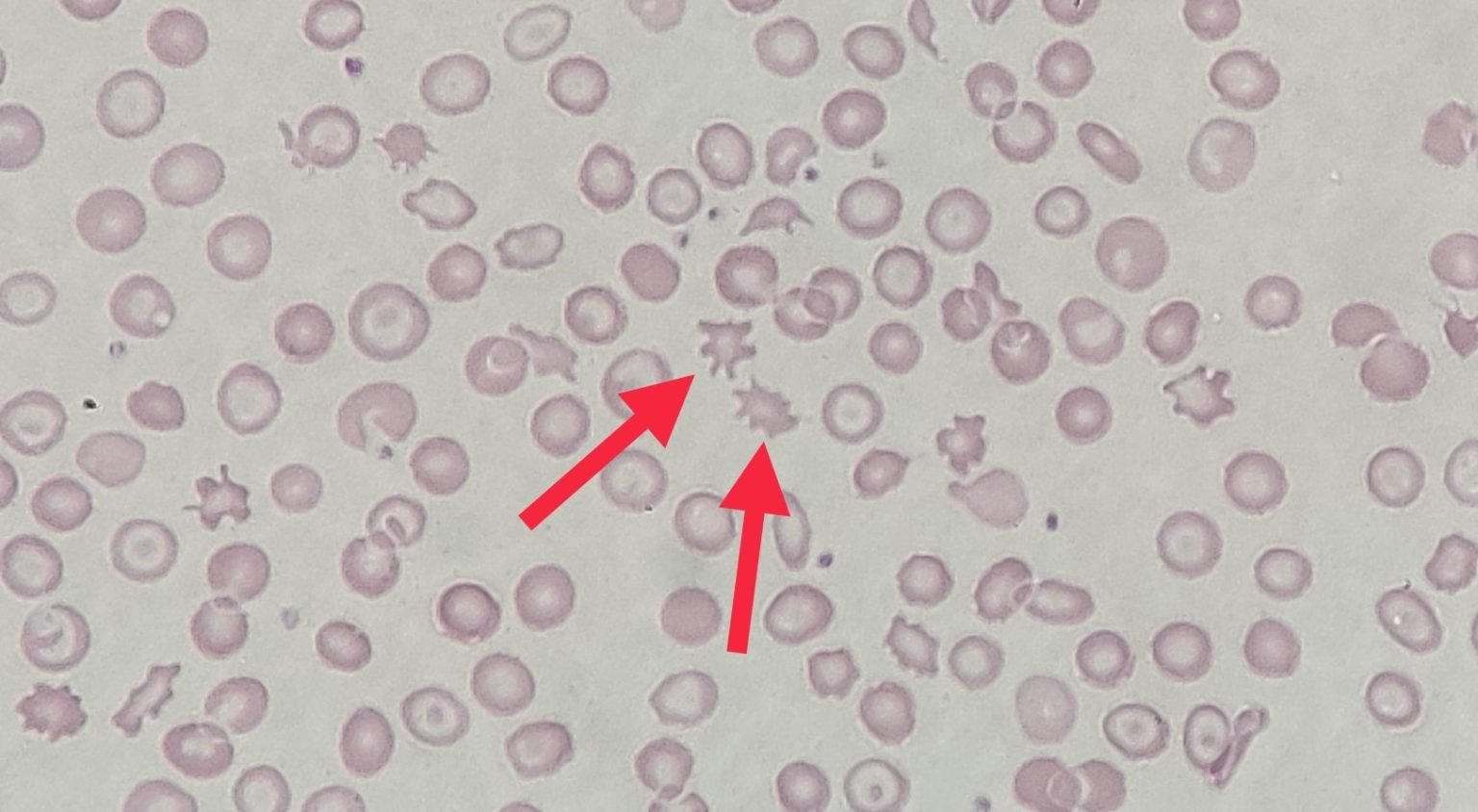 Red cells: Acanthocytes – Only Cells