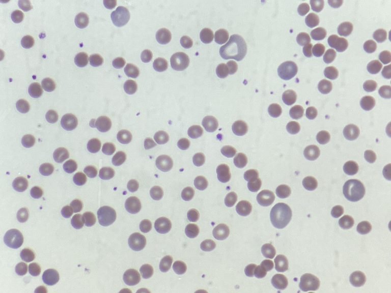 Red cells: Spherocytes – Only Cells