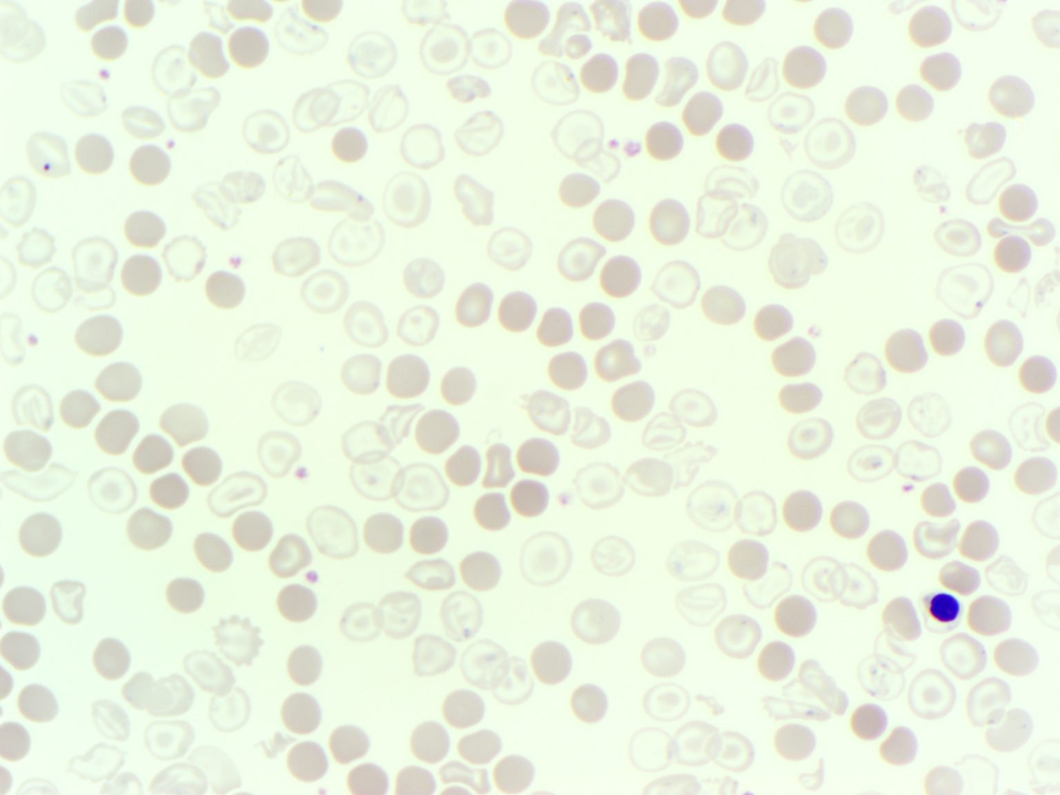 Red Cells: Dimorphism – Only Cells