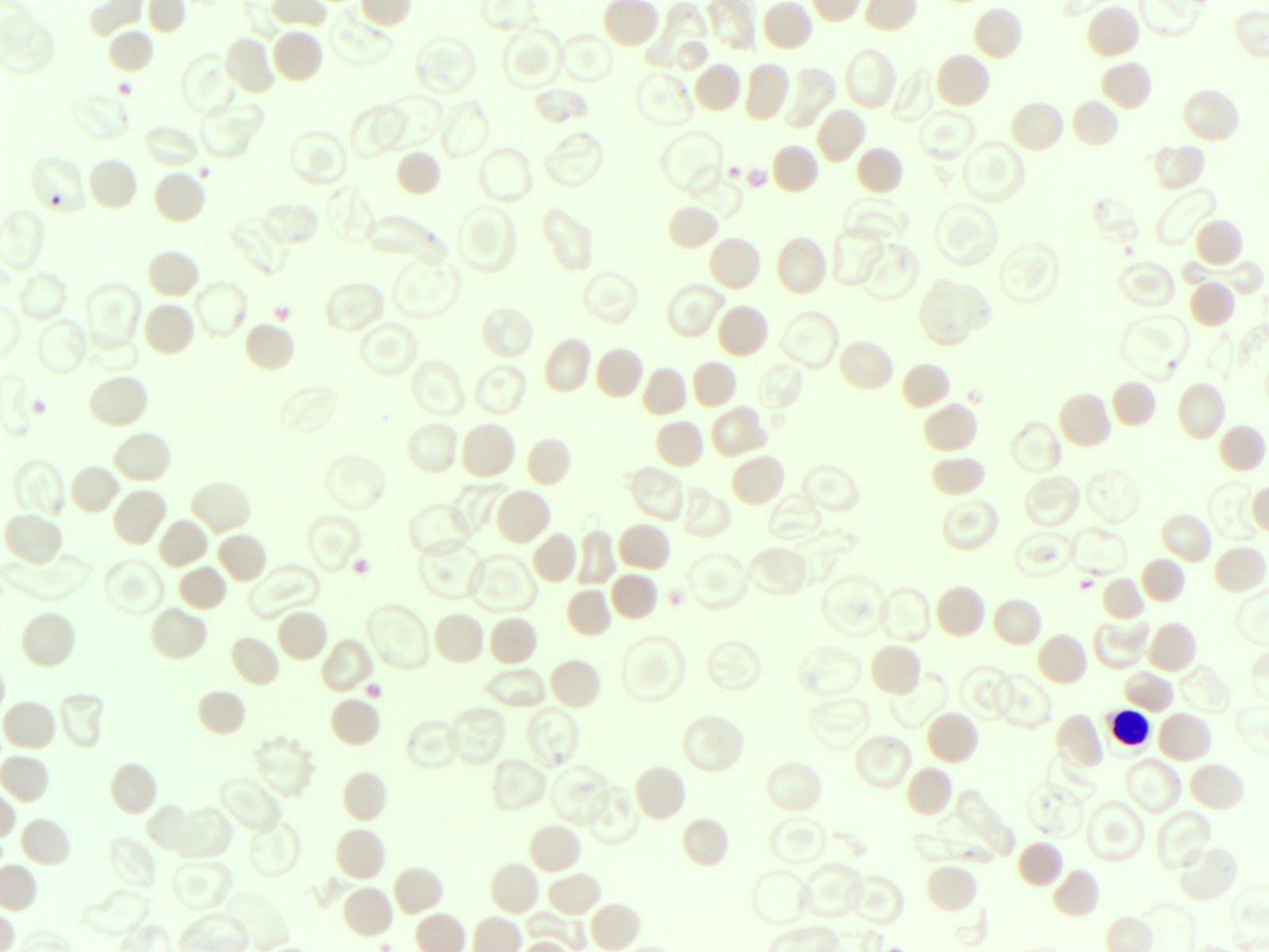 Red Cells: Dimorphism – Only Cells