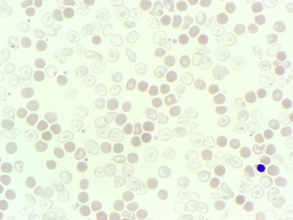 Red Cells: Dimorphism – Only Cells