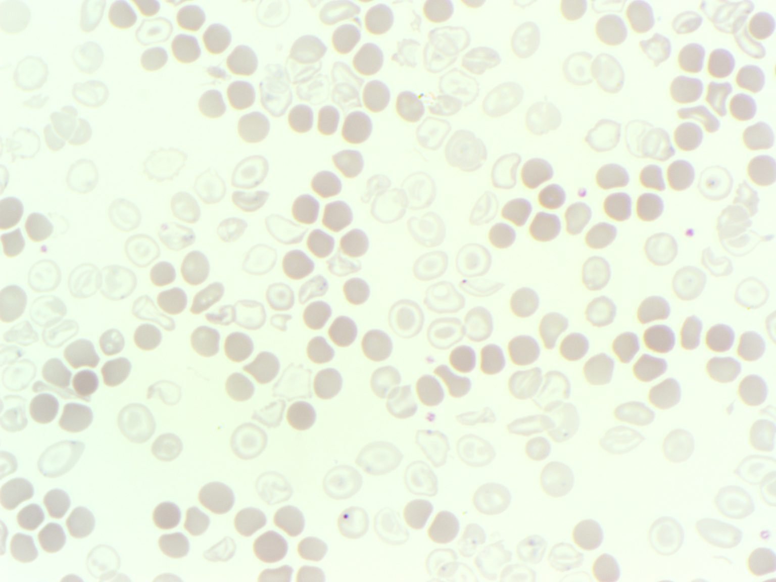 Red Cells: Dimorphism – Only Cells