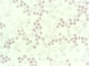 Red Cells: Dimorphism – Only Cells