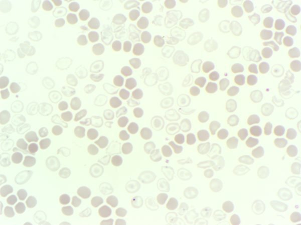 Red Cells: Dimorphism – Only Cells