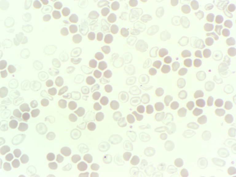 Red Cells: Dimorphism – Only Cells