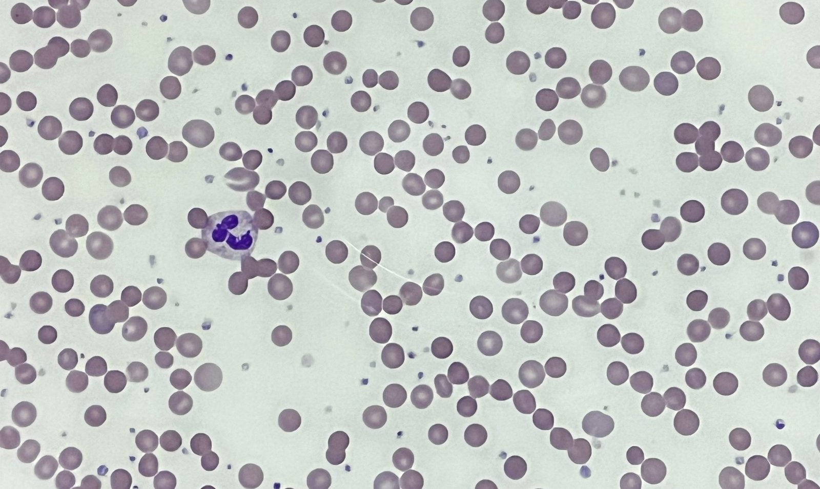 Red cells: Spherocytes – Only Cells