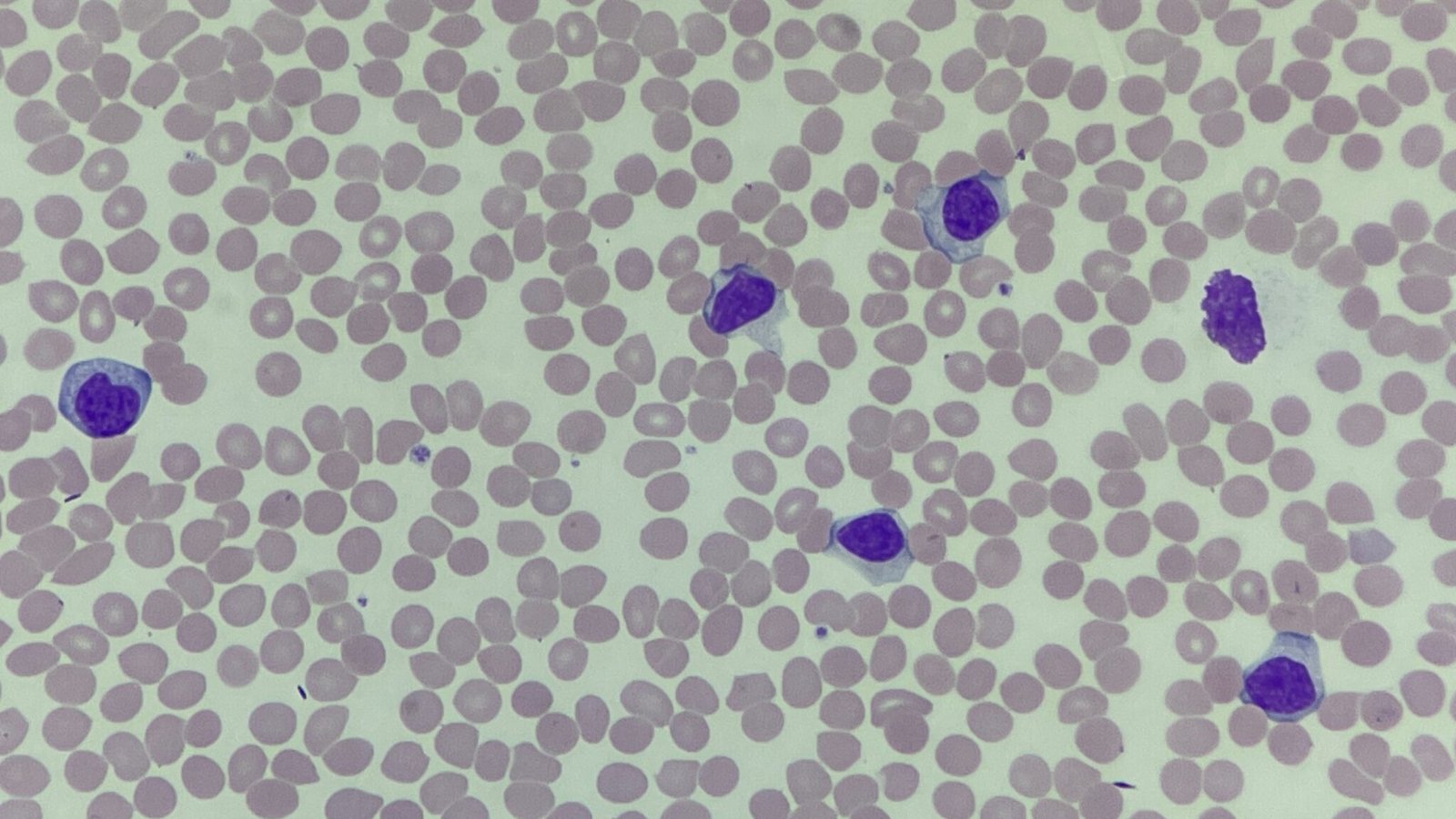 Infectious mononucleosis: when lymphocytes take centre stage – Only Cells