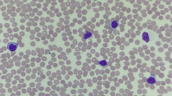 Infectious mononucleosis: when lymphocytes take centre stage – Only Cells