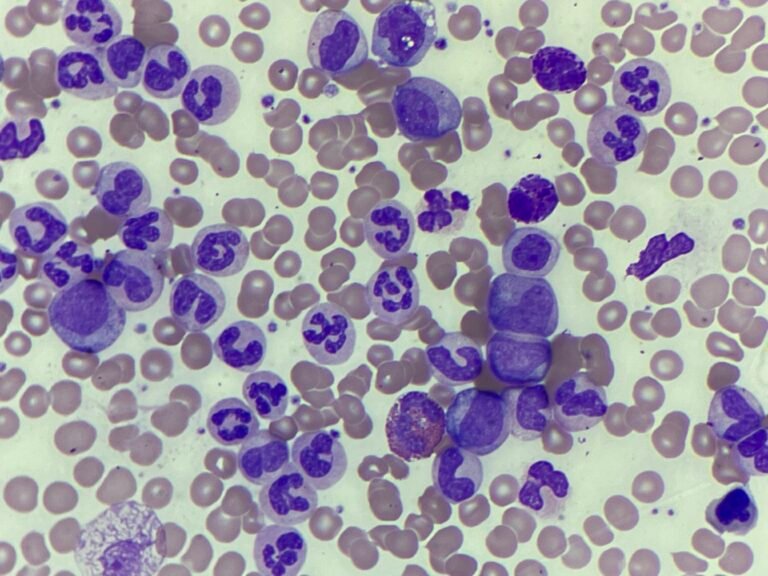 MM250609: Chronic myeloid leukaemia (CML) – Only Cells