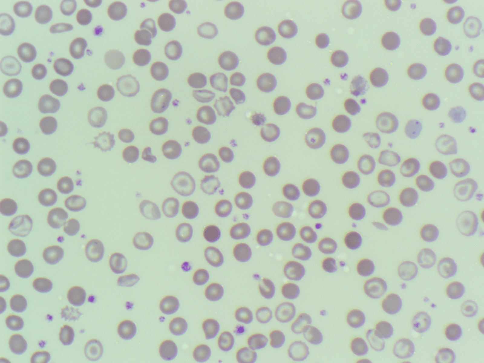 MM250714: Thalassaemia – Only Cells