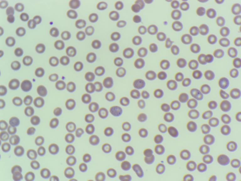 Red cells: Basophilic stippling – Only Cells