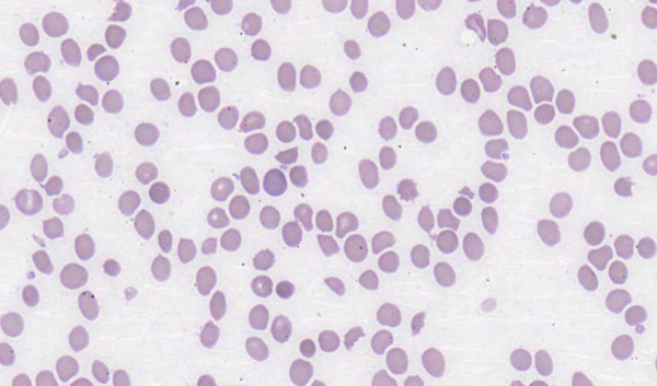 Haemolytic uraemic syndrome (HUS) – Only Cells