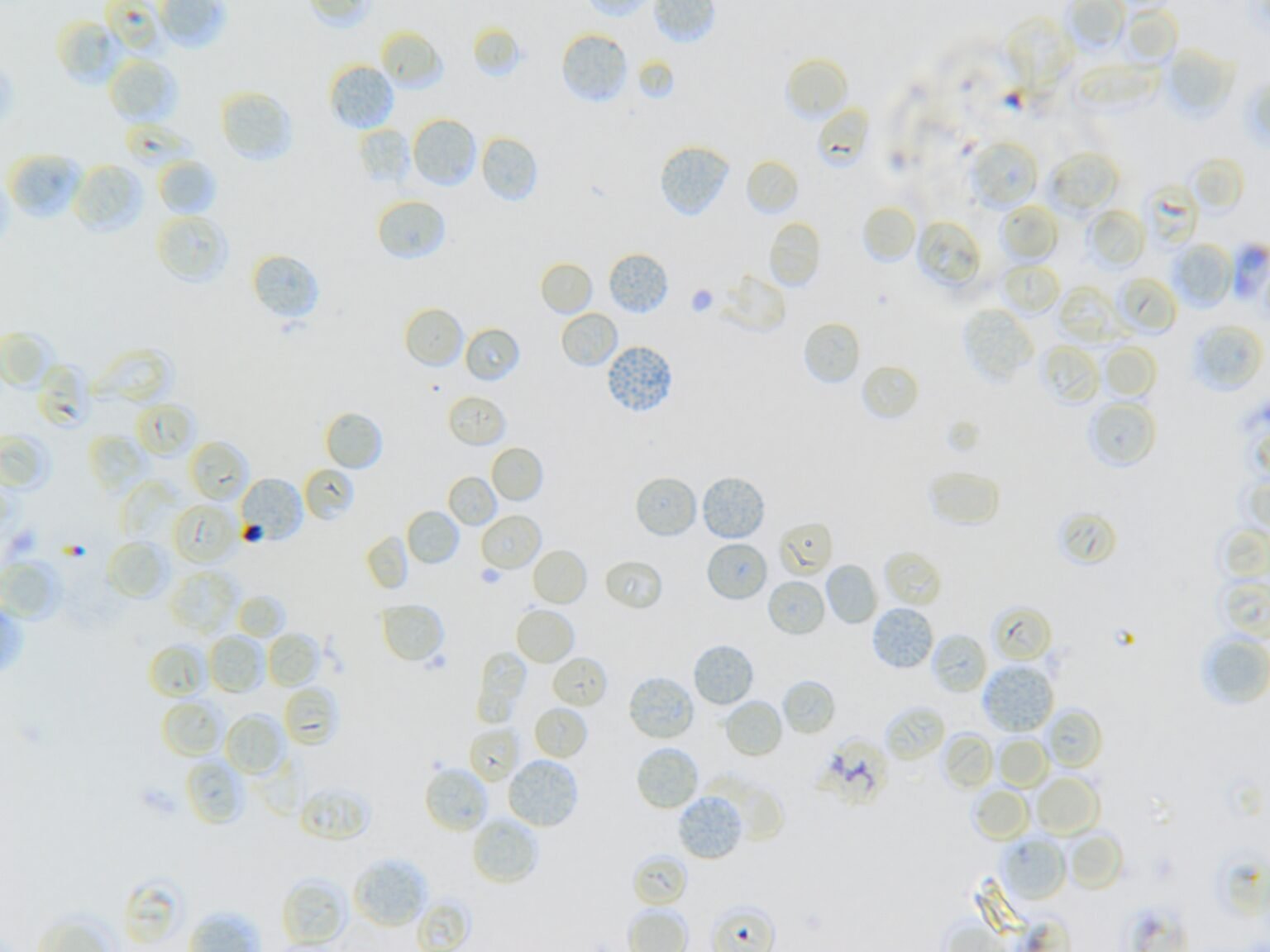 MM250915: Haemoglobin H disease – Only Cells